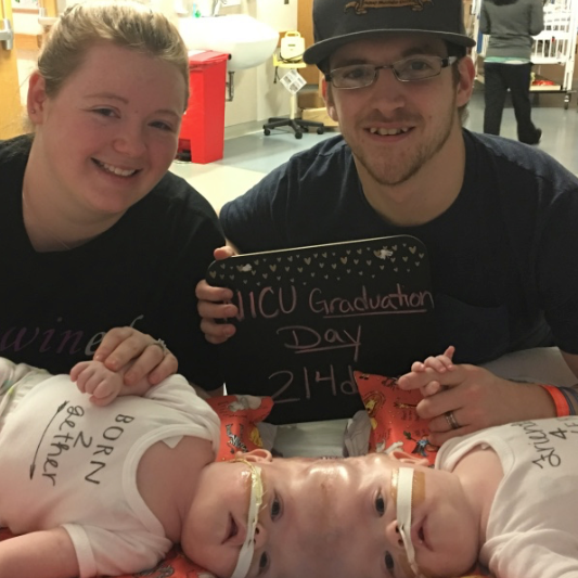 Delaney Twins conjoined at head separated before turning one